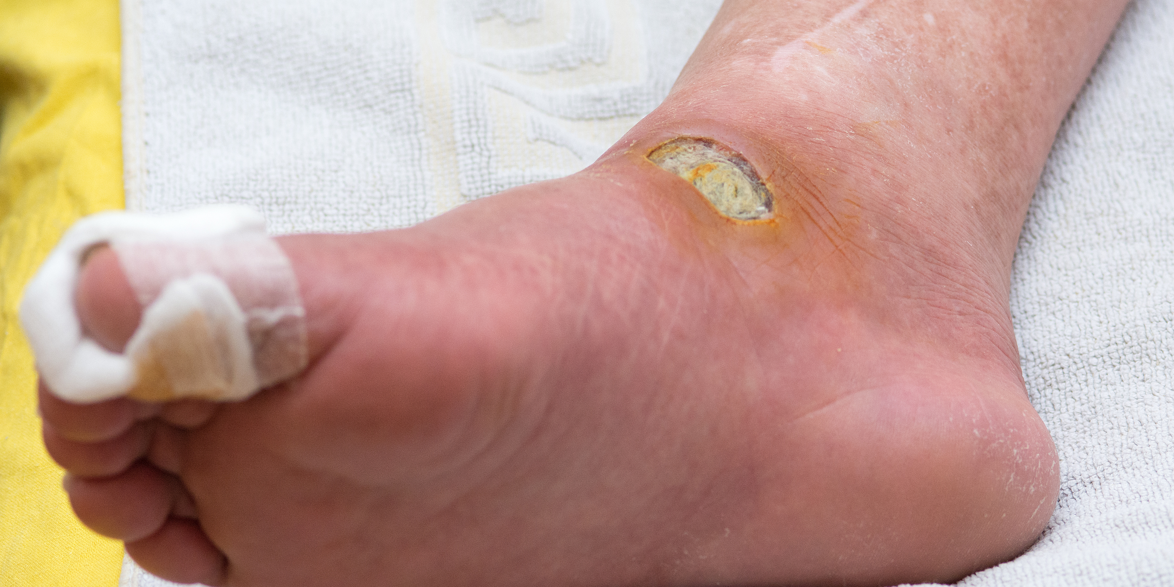 Especialista en Heridas